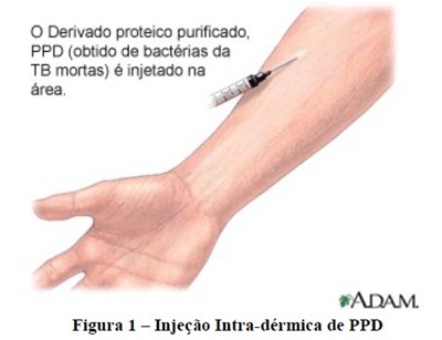 Teste Tuberculínico, Teste de Mantoux ou “PPD” | Biomedicina Padrão
